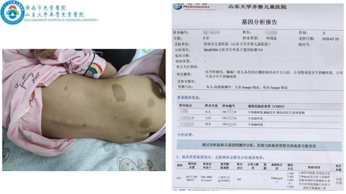 烟雾病综合症的诊断治疗及病例汇报 脑医汇 神外资讯 神介资讯