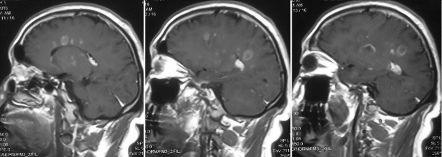 病例讨论| 华山脑胶质瘤MDT Tumor Board Case Review XIII - 脑医汇