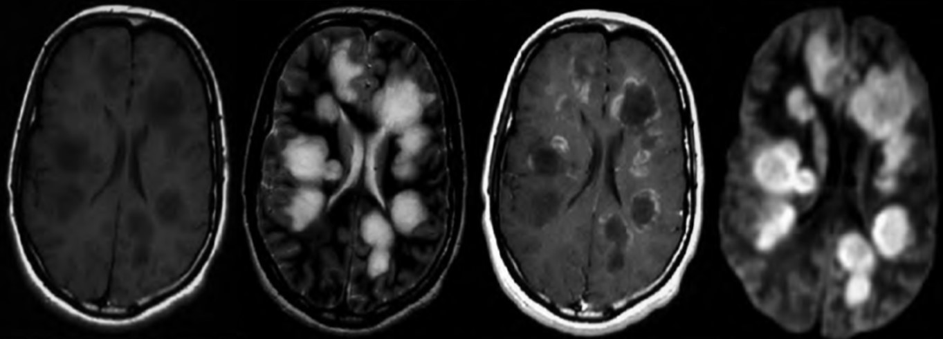 病例讨论| 华山脑胶质瘤MDT Tumor Board Case Review XIII - 脑医汇