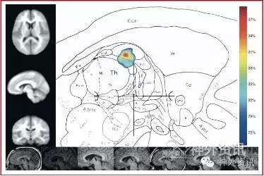 VTA-DBS治疗难治性慢性丛集性头痛 - 脑医汇