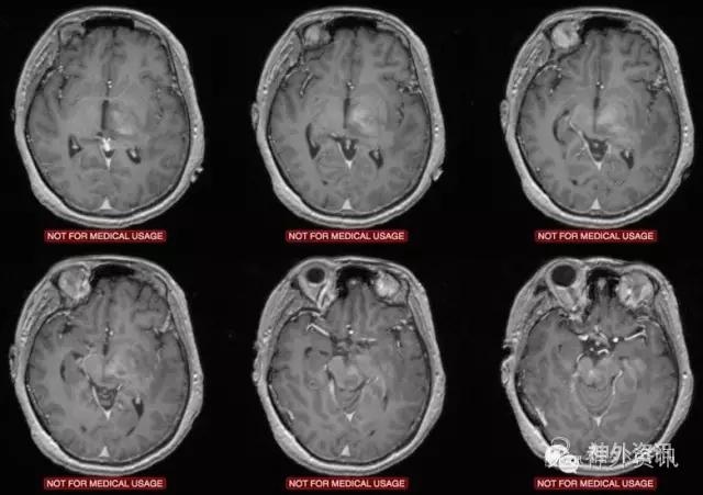 病例讨论| 华山脑胶质瘤MDT Tumor Board Case Review XIV - 脑医汇