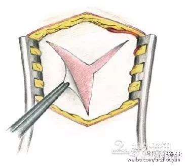 Keyhole手术入路--颞下开颅经硬膜外入路显露内听道之经岩尖扩大入路显露后颅窝 - 脑医汇