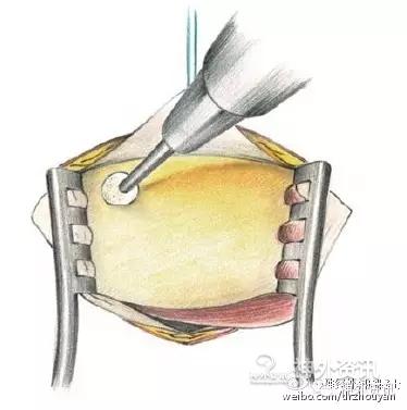 Keyhole手术入路--颞下开颅经硬膜外入路显露内听道之经岩尖扩大入路显露后颅窝 - 脑医汇