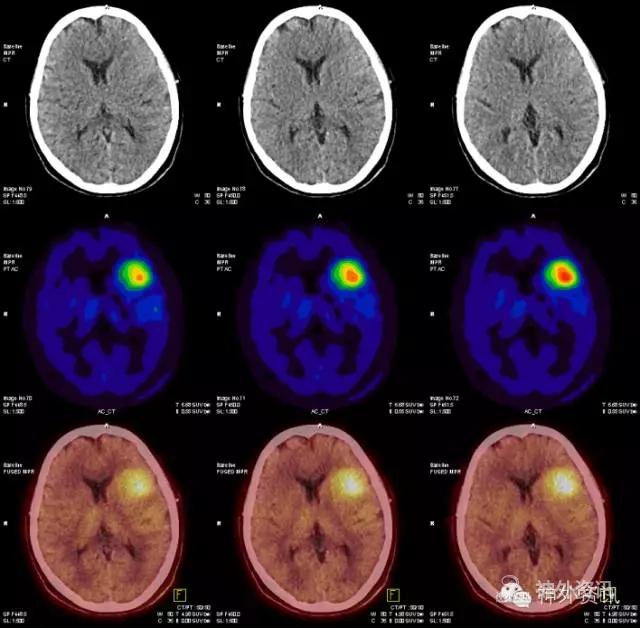 病例讨论| 华山脑胶质瘤MDT Tumor Board Case Review Ⅺ - 脑医汇