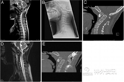 2例游离齿状突压迫脑干腹侧的治疗经验 - 脑医汇