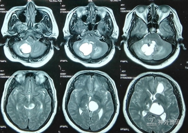 【罕见】病例讨论| 华山脑胶质瘤MDT Tumor Board Case Review XV - 脑医汇
