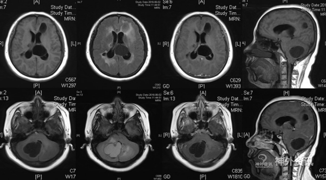 【罕见】病例讨论| 华山脑胶质瘤MDT Tumor Board Case Review XV - 脑医汇 - 神外资讯 - 神介资讯