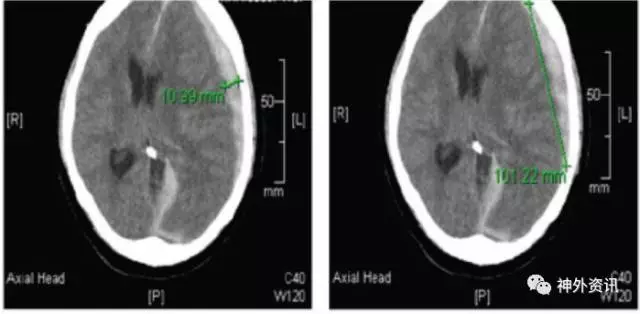 年龄与抗凝剂会影响aSDH的进展吗？ - 脑医汇