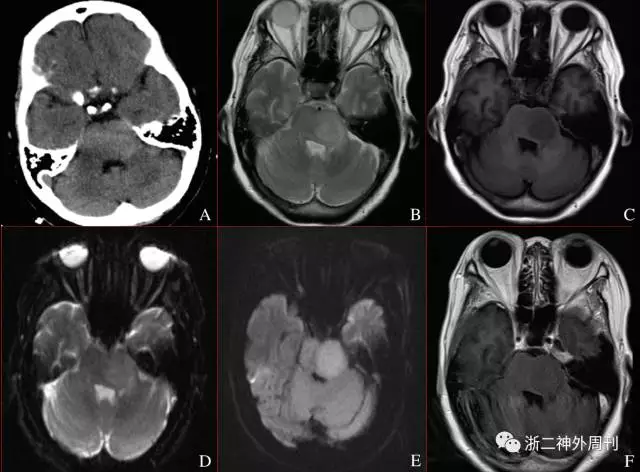 疑似DIPG的慢粒急变脑干浸润一例---浙二神外周刊（第100期） - 脑医汇 - 神外资讯 - 神介资讯