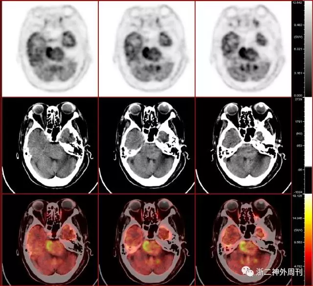 疑似DIPG的慢粒急变脑干浸润一例---浙二神外周刊（第100期） - 脑医汇 - 神外资讯 - 神介资讯