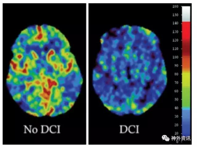 预测aSAH后迟发性脑缺血的发生 - 脑医汇