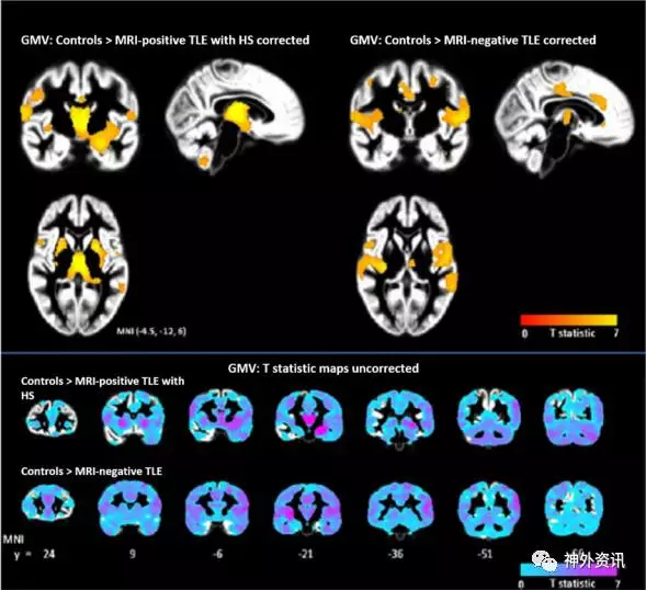 MRI阴性的颞叶癫痫是否手术？ - 脑医汇