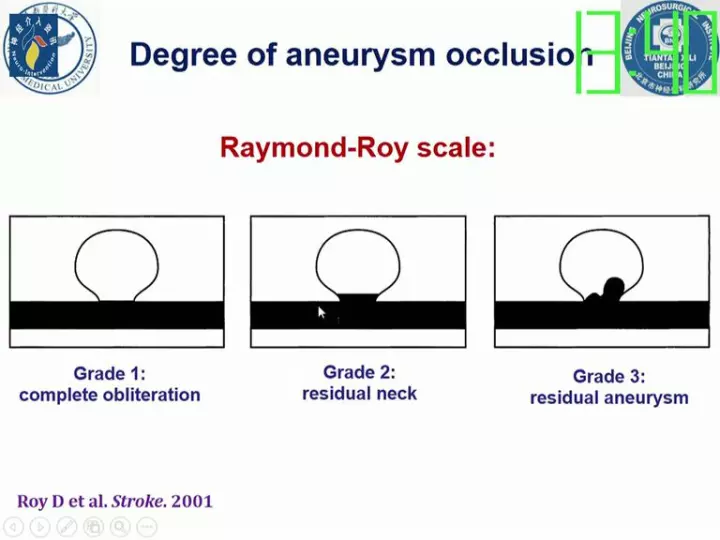 杨新健教授：动脉瘤栓塞弹簧圈的RCT研究—栓塞密度对瘤内愈合还重要吗？丨OCIN2017精彩回顾 - 脑医汇