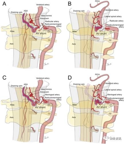 颅颈交界区动静脉瘘的血管构筑特点 - 脑医汇