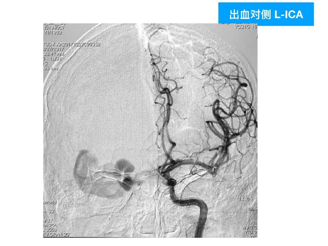 DAVF出血、脑疝急诊手术一例丨颅脑创伤-神经重症病例周刊（第49期） - 脑医汇 - 神外资讯 - 神介资讯