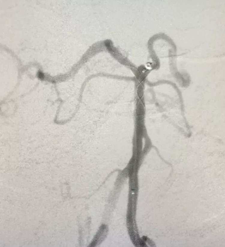 教学病例| 步步惊心：基底动脉顶端动脉瘤治疗一例 - 脑医汇