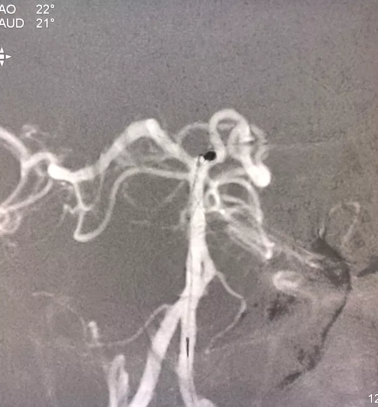 教学病例| 步步惊心：基底动脉顶端动脉瘤治疗一例 - 脑医汇