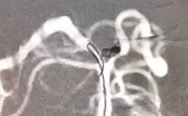 教学病例| 步步惊心：基底动脉顶端动脉瘤治疗一例 - 脑医汇