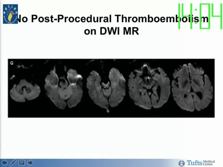 Adel Malek：Neuroform Atlas支架在颅内动脉瘤治疗中的应用丨OCIN2017精彩回顾 - 脑医汇