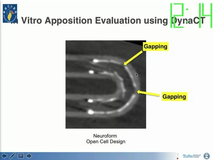 Adel Malek：Neuroform Atlas支架在颅内动脉瘤治疗中的应用丨OCIN2017精彩回顾 - 脑医汇