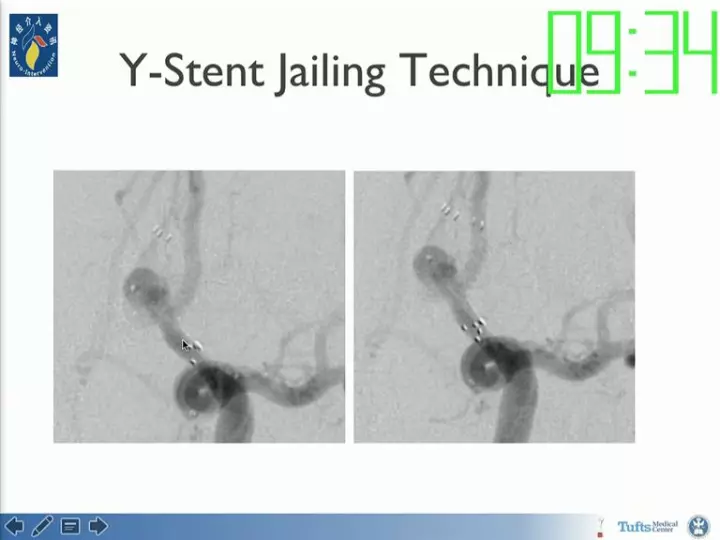 Adel Malek：Neuroform Atlas支架在颅内动脉瘤治疗中的应用丨OCIN2017精彩回顾 - 脑医汇