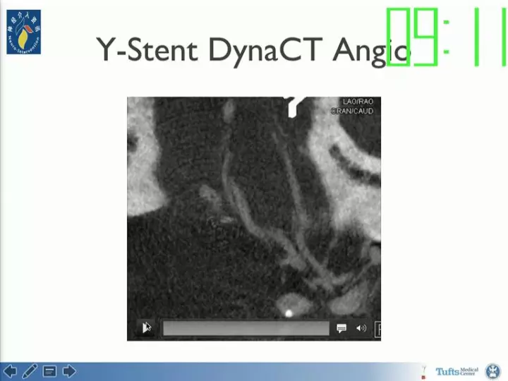 Adel Malek：Neuroform Atlas支架在颅内动脉瘤治疗中的应用丨OCIN2017精彩回顾 - 脑医汇