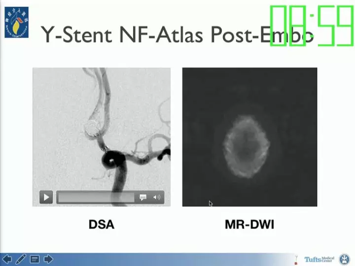 Adel Malek：Neuroform Atlas支架在颅内动脉瘤治疗中的应用丨OCIN2017精彩回顾 - 脑医汇