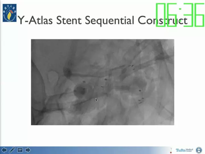 Adel Malek：Neuroform Atlas支架在颅内动脉瘤治疗中的应用丨OCIN2017精彩回顾 - 脑医汇
