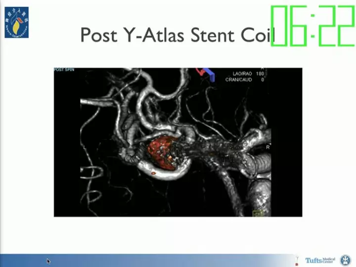 Adel Malek：Neuroform Atlas支架在颅内动脉瘤治疗中的应用丨OCIN2017精彩回顾 - 脑医汇