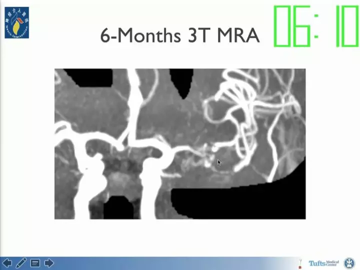 Adel Malek：Neuroform Atlas支架在颅内动脉瘤治疗中的应用丨OCIN2017精彩回顾 - 脑医汇