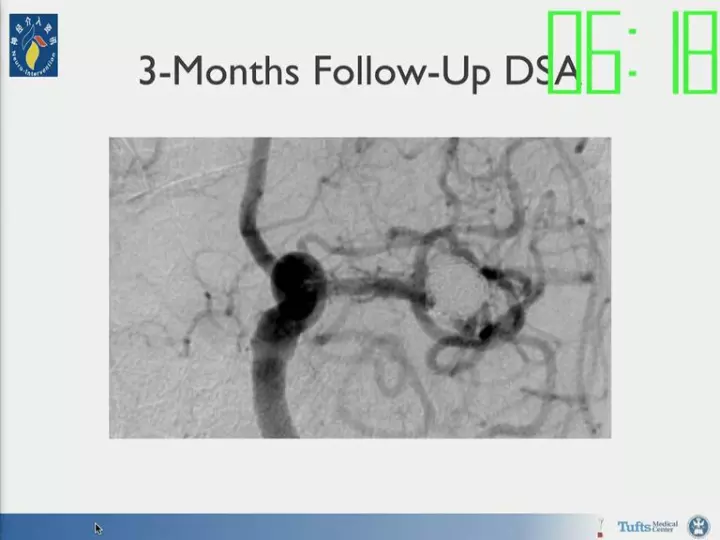 Adel Malek：Neuroform Atlas支架在颅内动脉瘤治疗中的应用丨OCIN2017精彩回顾 - 脑医汇
