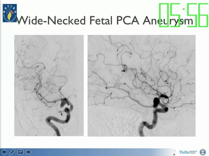 Adel Malek：Neuroform Atlas支架在颅内动脉瘤治疗中的应用丨OCIN2017精彩回顾 - 脑医汇