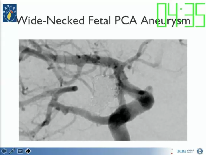 Adel Malek：Neuroform Atlas支架在颅内动脉瘤治疗中的应用丨OCIN2017精彩回顾 - 脑医汇