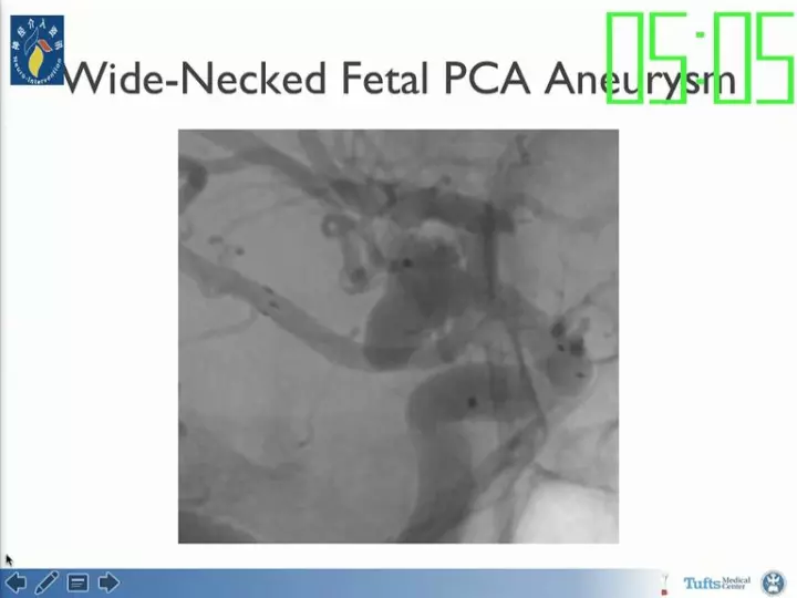 Adel Malek：Neuroform Atlas支架在颅内动脉瘤治疗中的应用丨OCIN2017精彩回顾 - 脑医汇