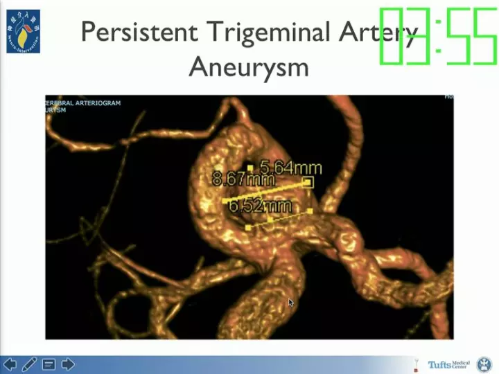 Adel Malek：Neuroform Atlas支架在颅内动脉瘤治疗中的应用丨OCIN2017精彩回顾 - 脑医汇