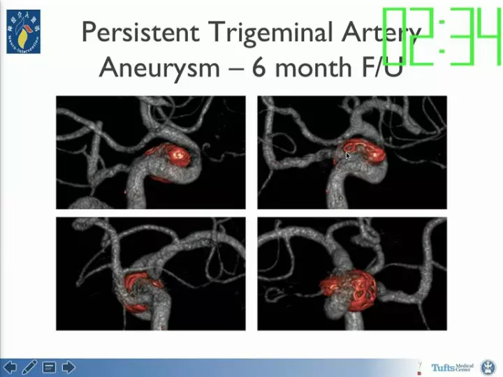 Adel Malek：Neuroform Atlas支架在颅内动脉瘤治疗中的应用丨OCIN2017精彩回顾 - 脑医汇
