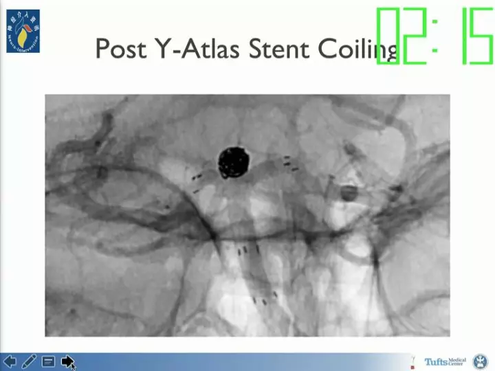 Adel Malek：Neuroform Atlas支架在颅内动脉瘤治疗中的应用丨OCIN2017精彩回顾 - 脑医汇