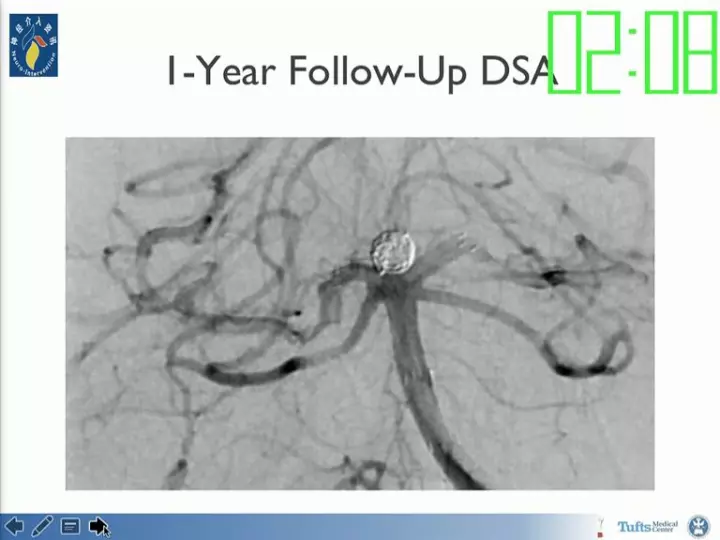 Adel Malek：Neuroform Atlas支架在颅内动脉瘤治疗中的应用丨OCIN2017精彩回顾 - 脑医汇