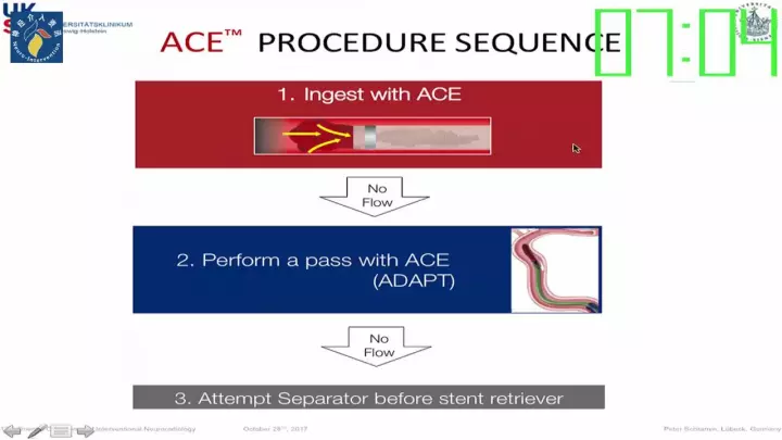 ACE抽吸导管的经验技巧丨OCIN2017精彩回顾 - 脑医汇