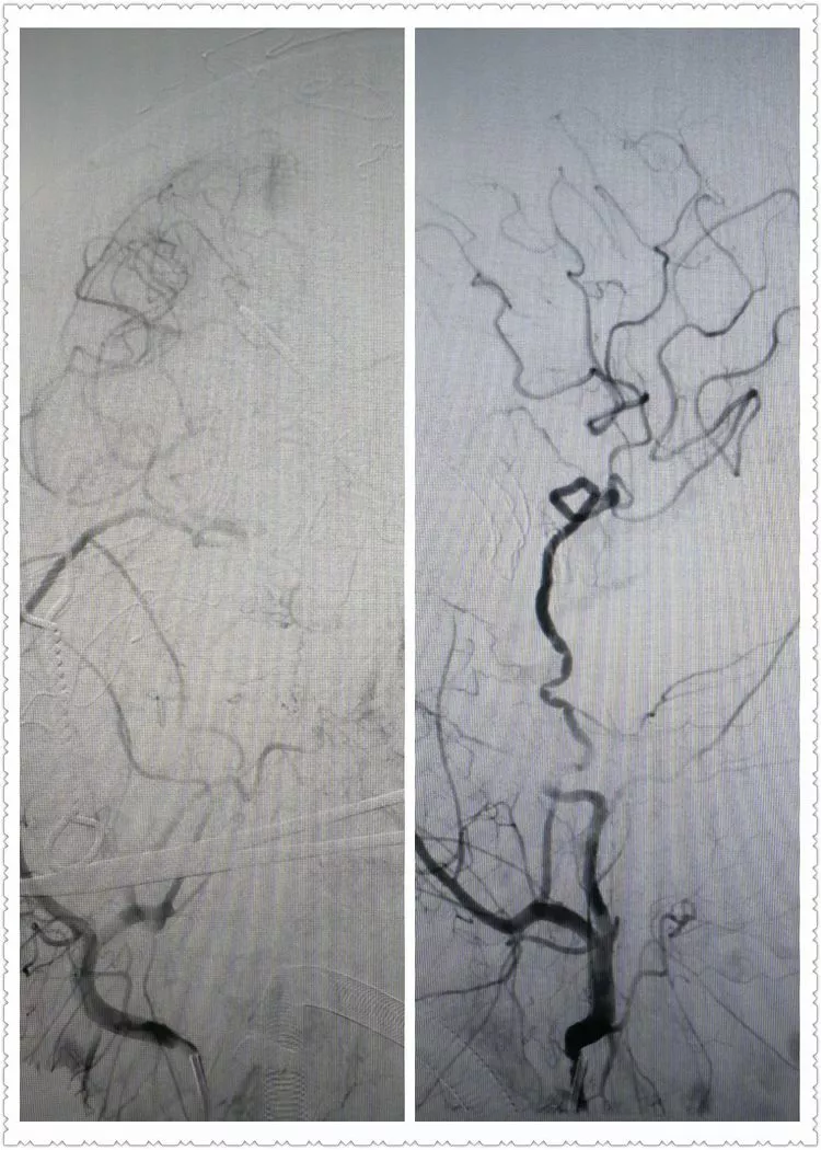 病例分享| BBA覆膜支架术后残留复发搭桥+包裹夹闭术一例 - 脑医汇 - 神外资讯 - 神介资讯