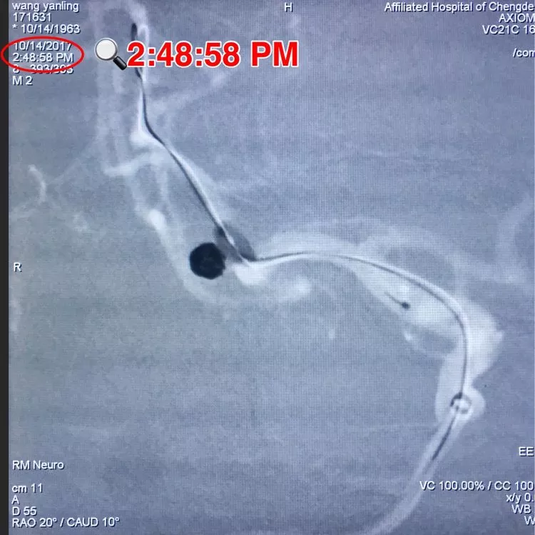 病例分享| 速度与激情 - 脑医汇