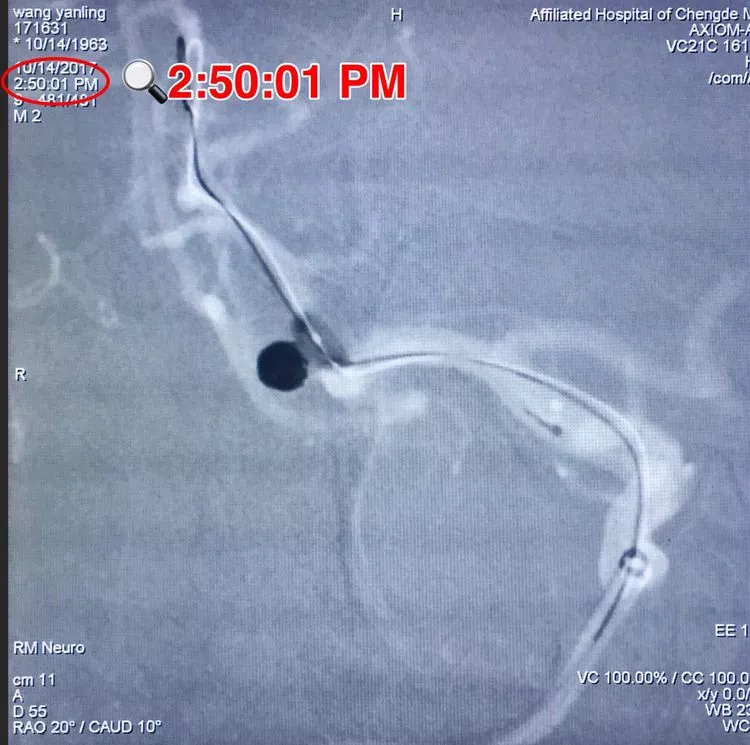 病例分享| 速度与激情 - 脑医汇