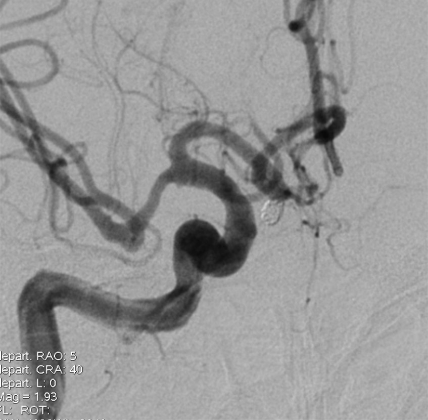 刘俊教授谈Axium Prime ES 弹簧圈：小动脉瘤致密栓塞武器 - 脑医汇