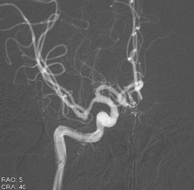 刘俊教授谈Axium Prime ES 弹簧圈：小动脉瘤致密栓塞武器 - 脑医汇