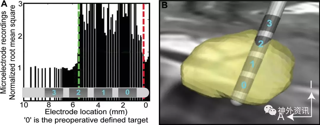 MER验证7T-ML方法定位STN的精确度 - 脑医汇