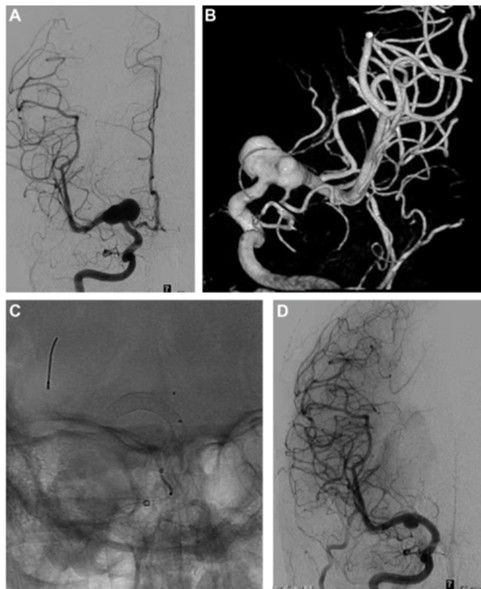 Pipeline治疗颈内动脉末端分叉处动脉瘤 - 脑医汇