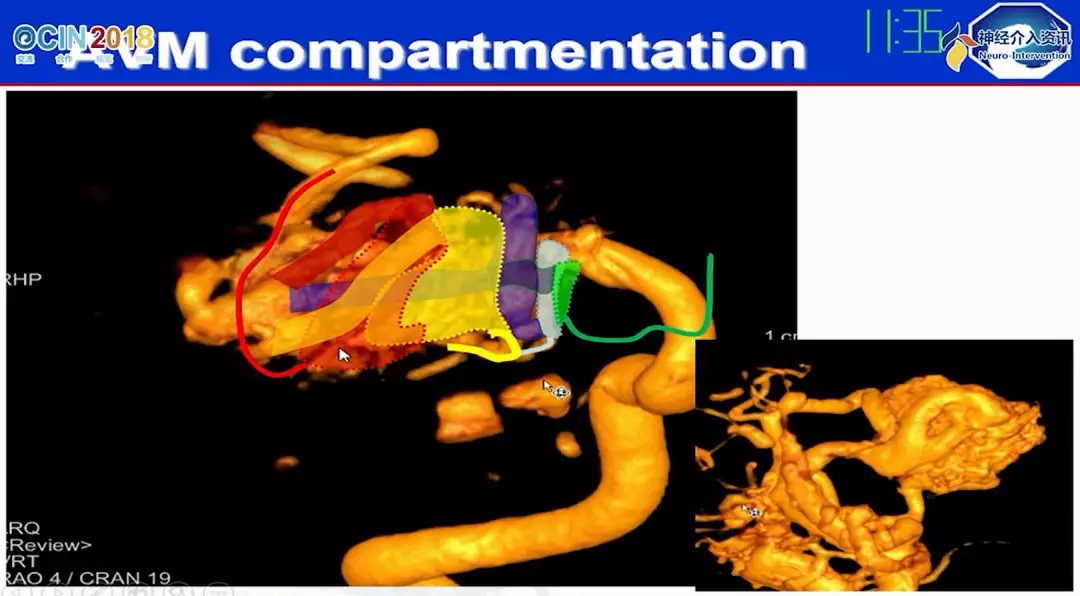 【OCIN许奕】脑AVM治愈性栓塞的总体策略 - 脑医汇