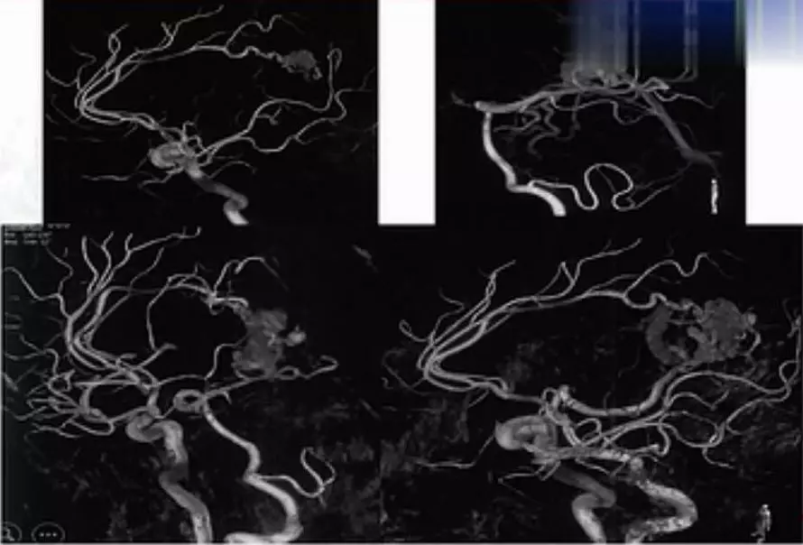 【OCIN许奕】脑AVM治愈性栓塞的总体策略 - 脑医汇