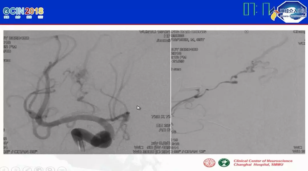 【OCIN许奕】脑AVM治愈性栓塞的总体策略 - 脑医汇