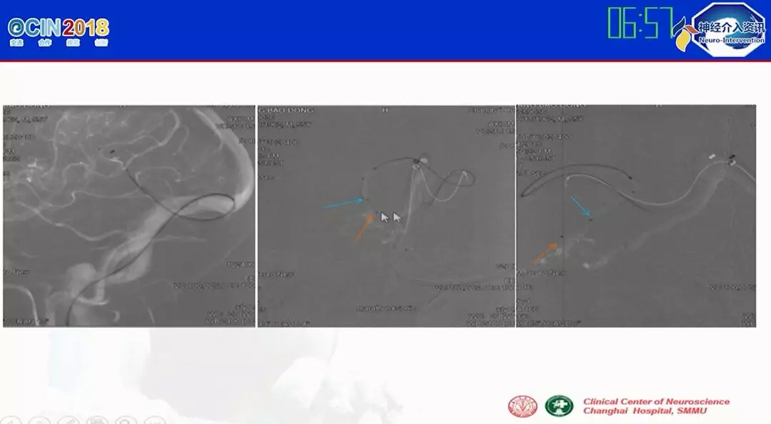 【OCIN许奕】脑AVM治愈性栓塞的总体策略 - 脑医汇